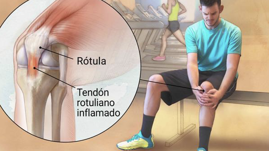 ¿QUÉ ES UNA TENDINITIS ROTULIANA? | Trauma SOS Ecuador